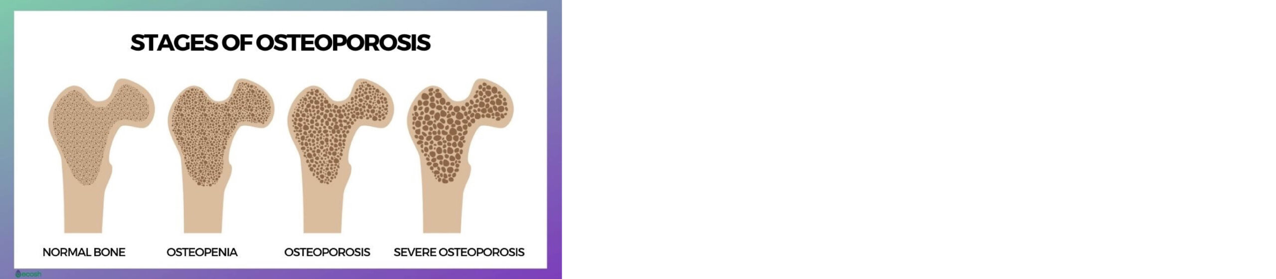 bone density blog graphics - Maximum Performance